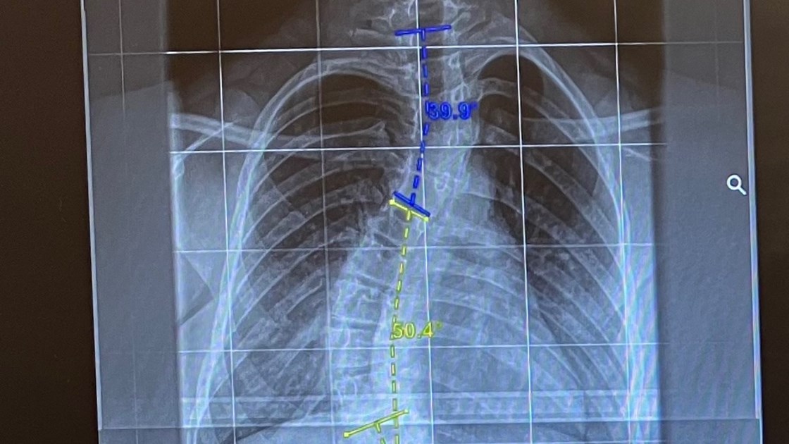 Jude Barrett is fundraising for Scoliosis Support and Research