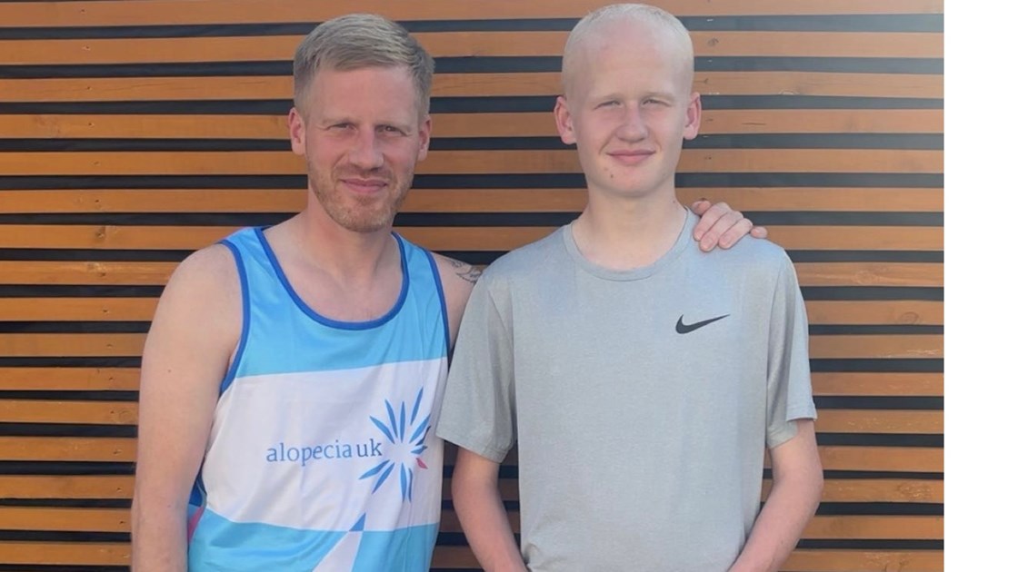 Chris Fellows is fundraising for Alopecia UK