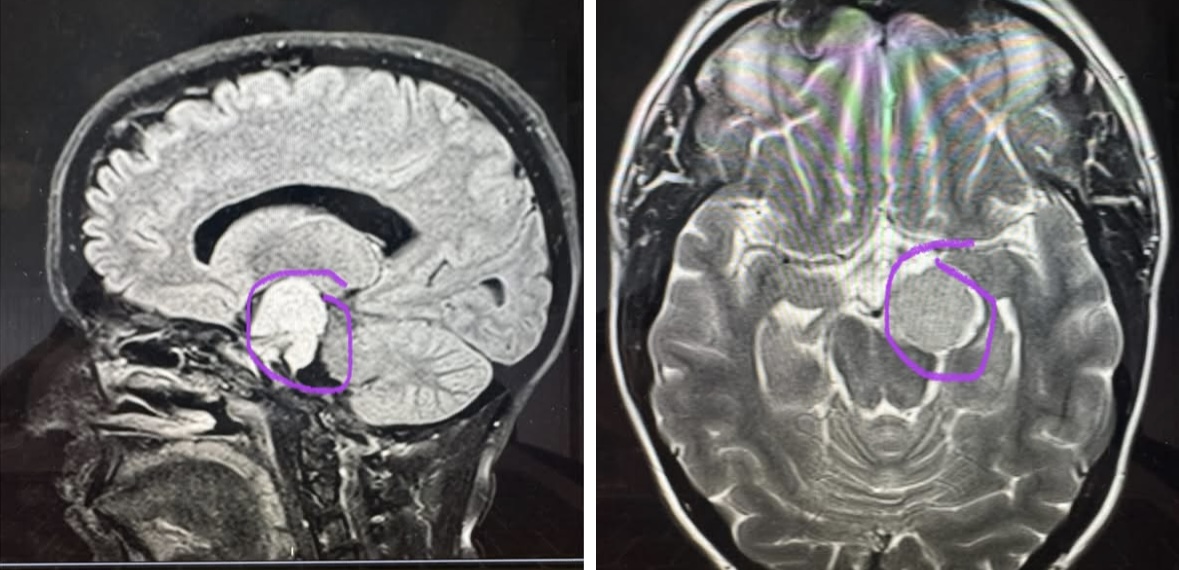 Camille Hayes is fundraising for The Brain Tumour Charity