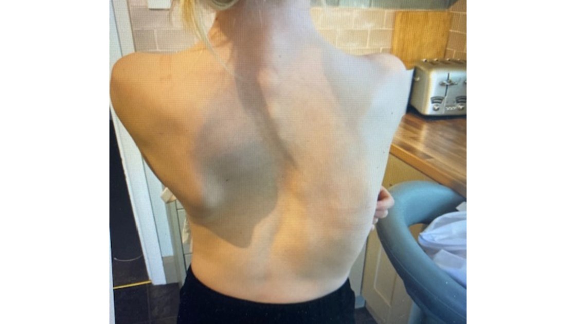 Wayne Ingram is fundraising for Scoliosis Support and Research