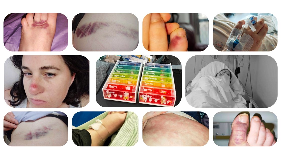 Lynsey Michelle Turner is fundraising for Epilepsy Action